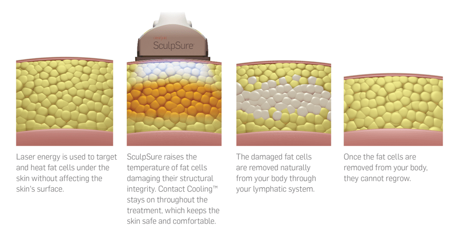 SCULPSURE BODY CONTOURING – Evolution Medical & Laser